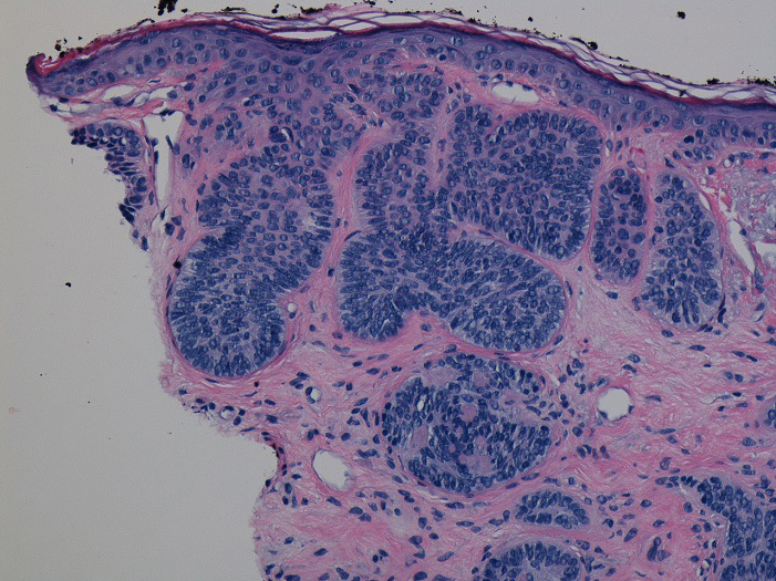 Basal Cell Carcinoma Treated by Dermatologists in Baltimore - Mercy ...