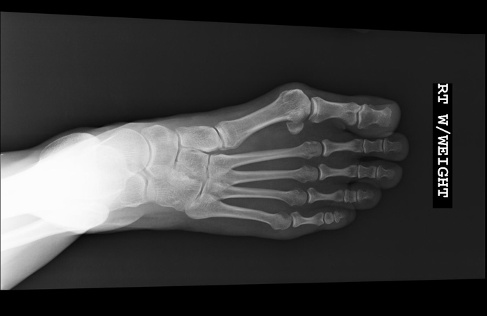 Hallux Valgus Bunion Deformity Treated by Foot Surgeons in Baltimore ...