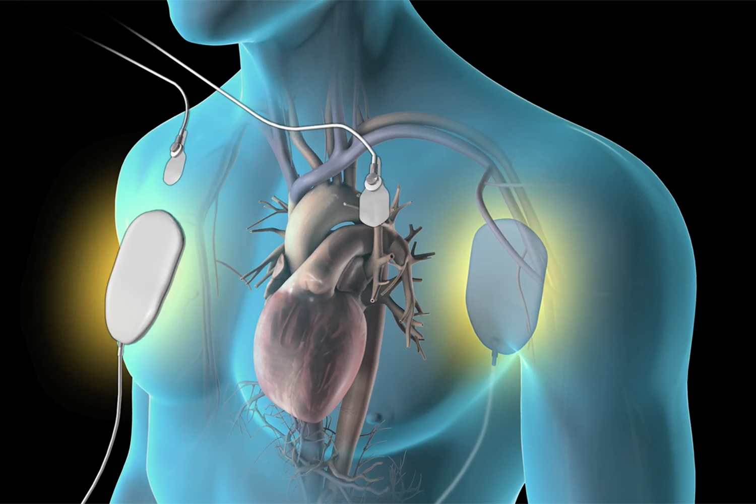Cardioversion Offered at Mercy Medical Center in Baltimore