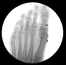 Hallux Varus Treated by Top Foot Surgeons - Mercy in Baltimore