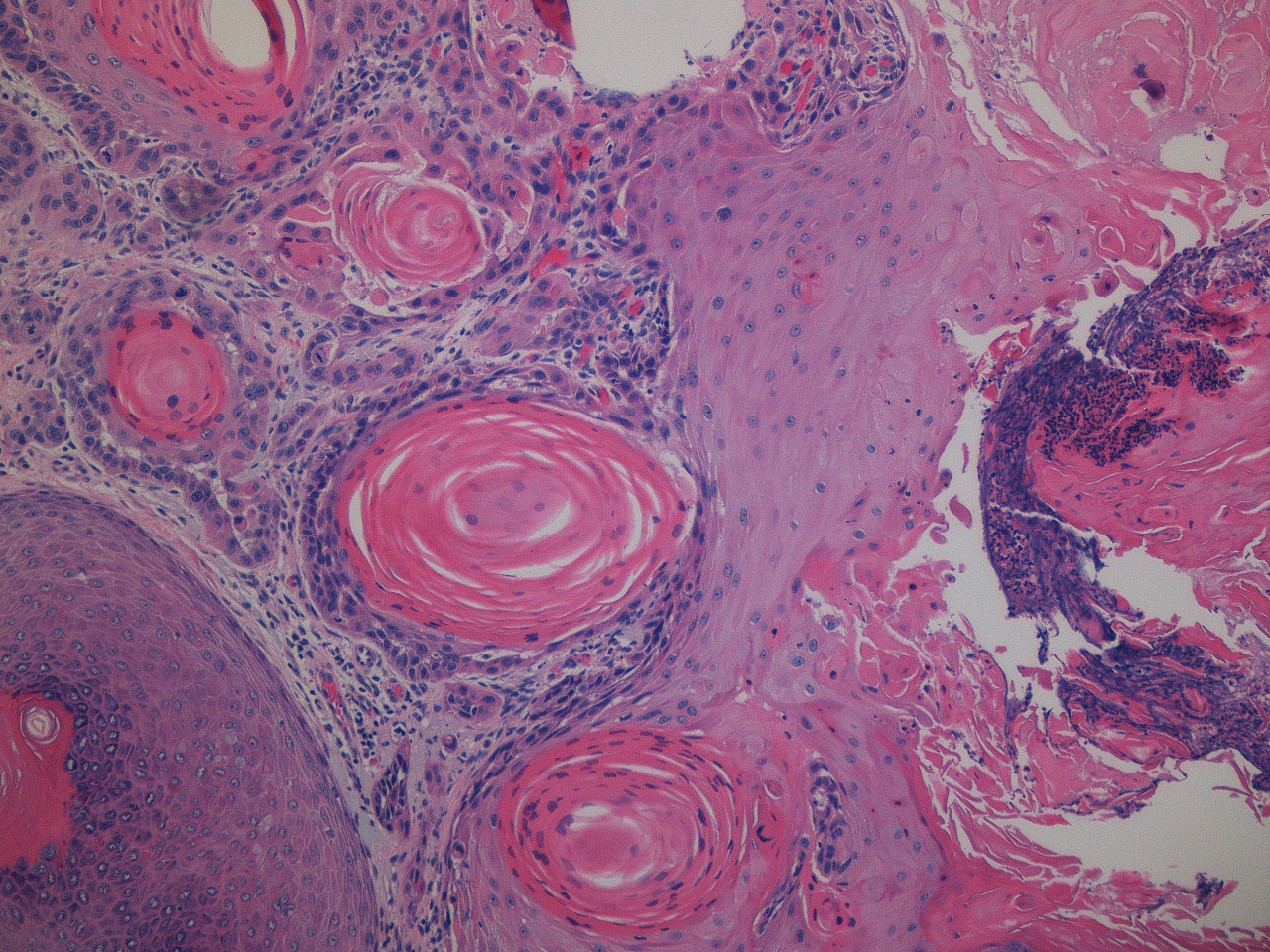 Basal Cell Carcinoma Treated by Dermatologists in Baltimore - Mercy ...