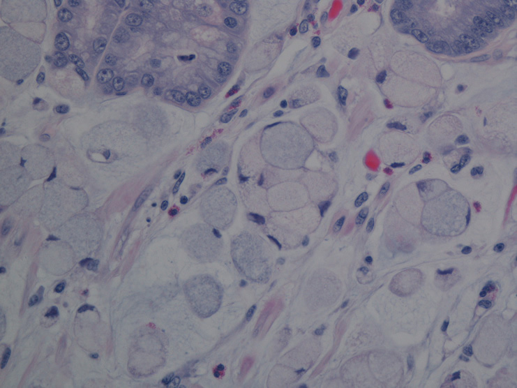 Stomach Cancer, Gastric Cancer Diagnosed and Treated in Baltimore - Mercy